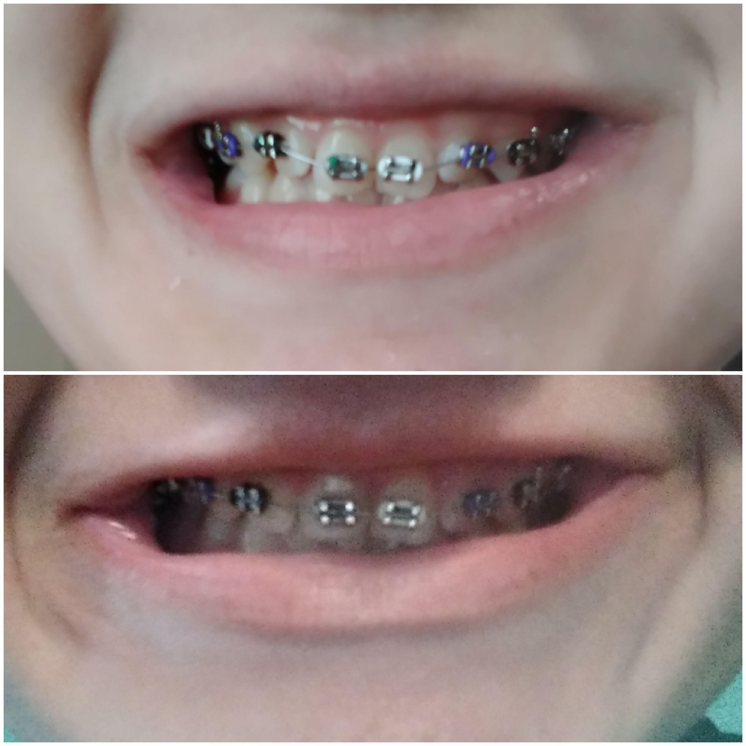 It's been a whole month since I got braces (top is day 1, bottom is today) | Scrolller