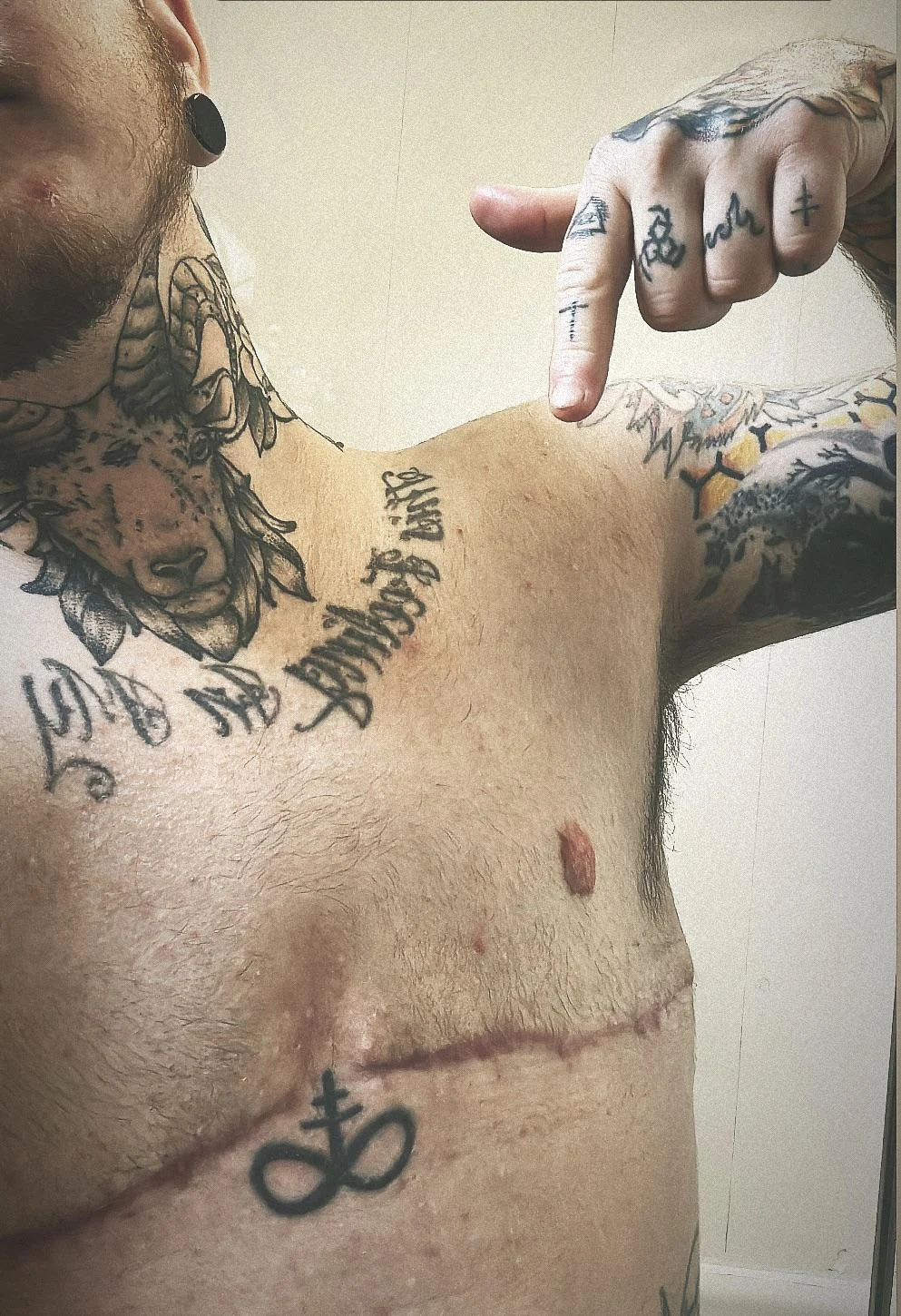 I’m almost 3 months post op! | Scrolller