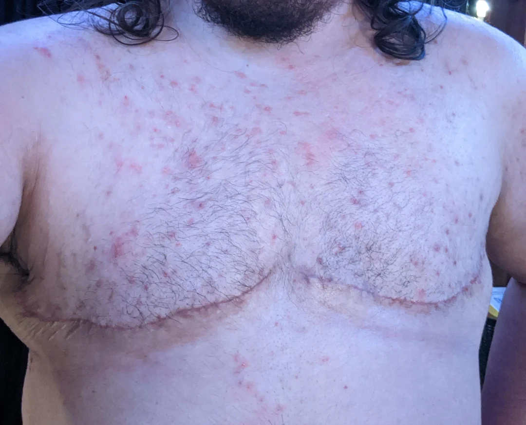 5 Weeks Post Op! | Scrolller