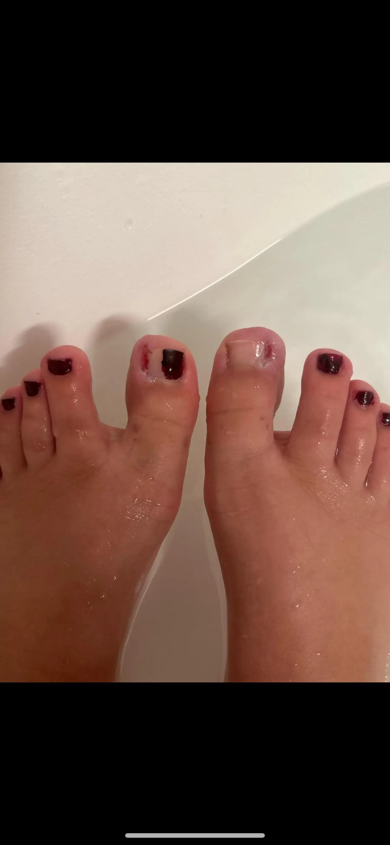 2 days after removal | Scrolller