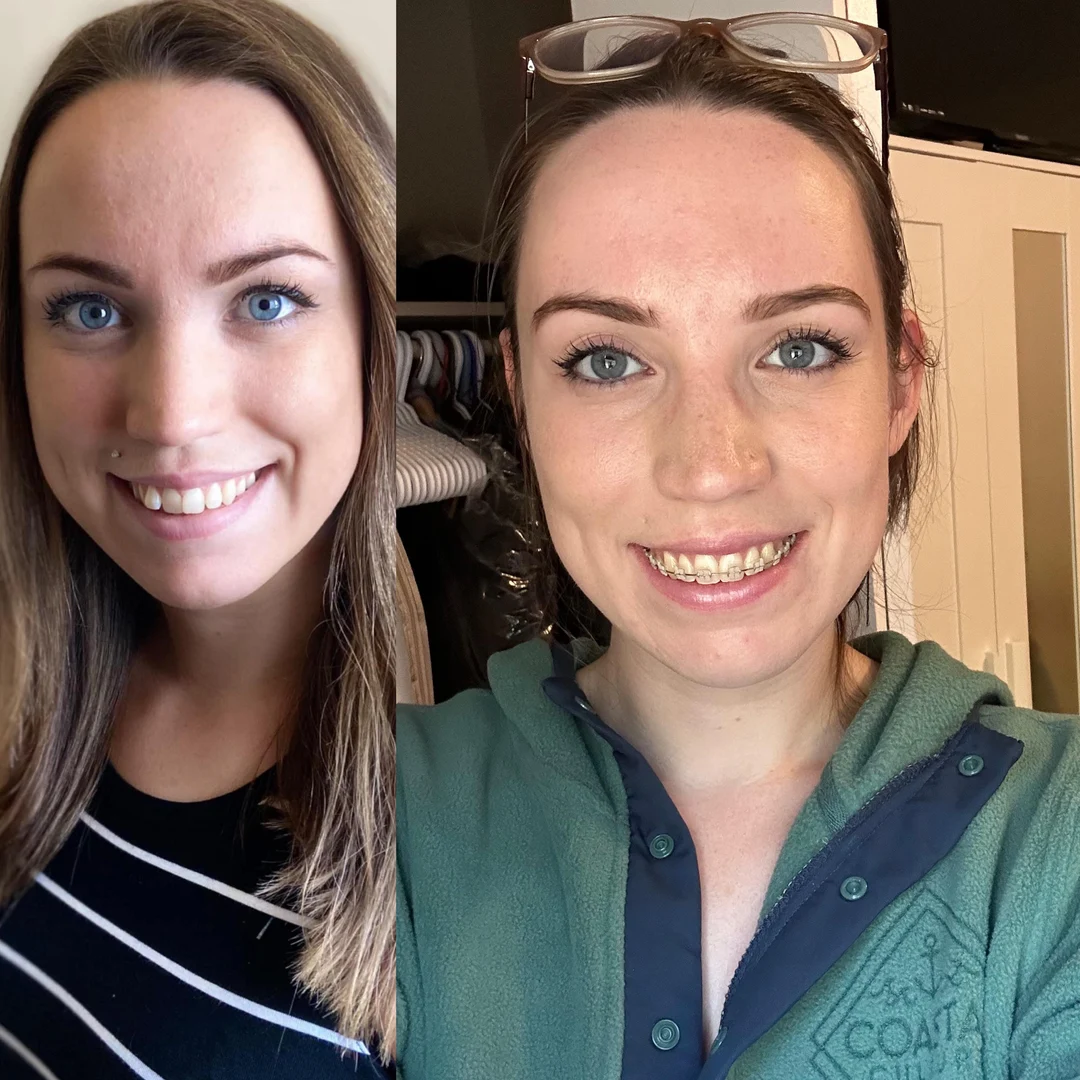 Adult Braces Progress Scrolller