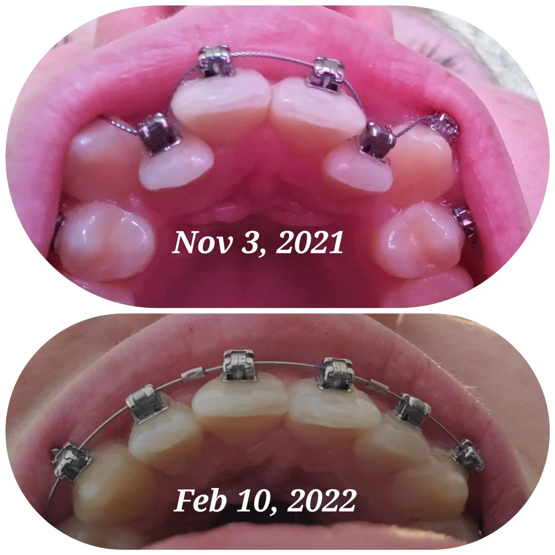 Just had my first adjustment :) anyone know what the little metal bands on the wire are? | Scrolller