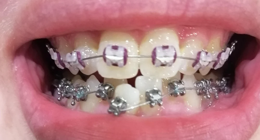 just got bottom braces and bite blocks | Scrolller