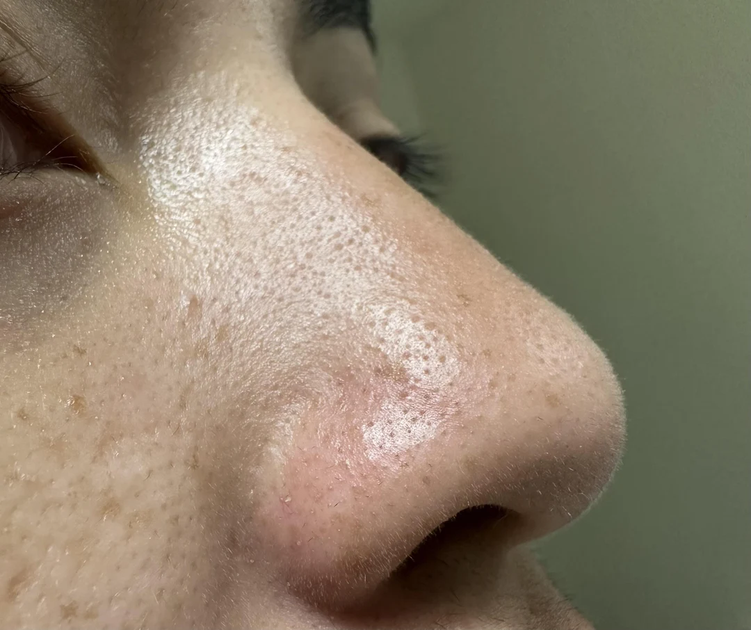how to get rid of texture on my nose | Scrolller