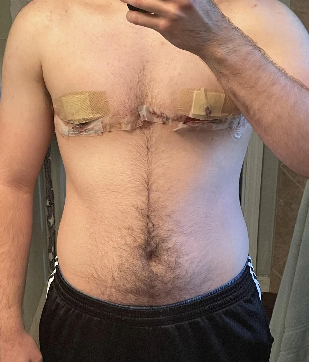Two days post op :) | Scrolller
