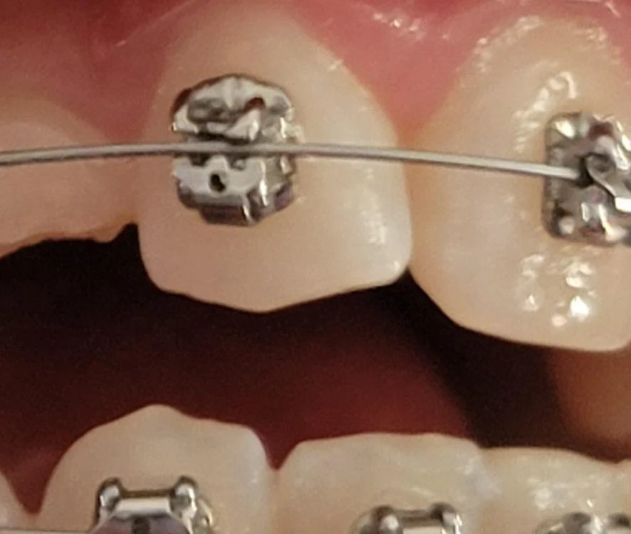 Is the wire supposed to be outside the bracket? | Scrolller