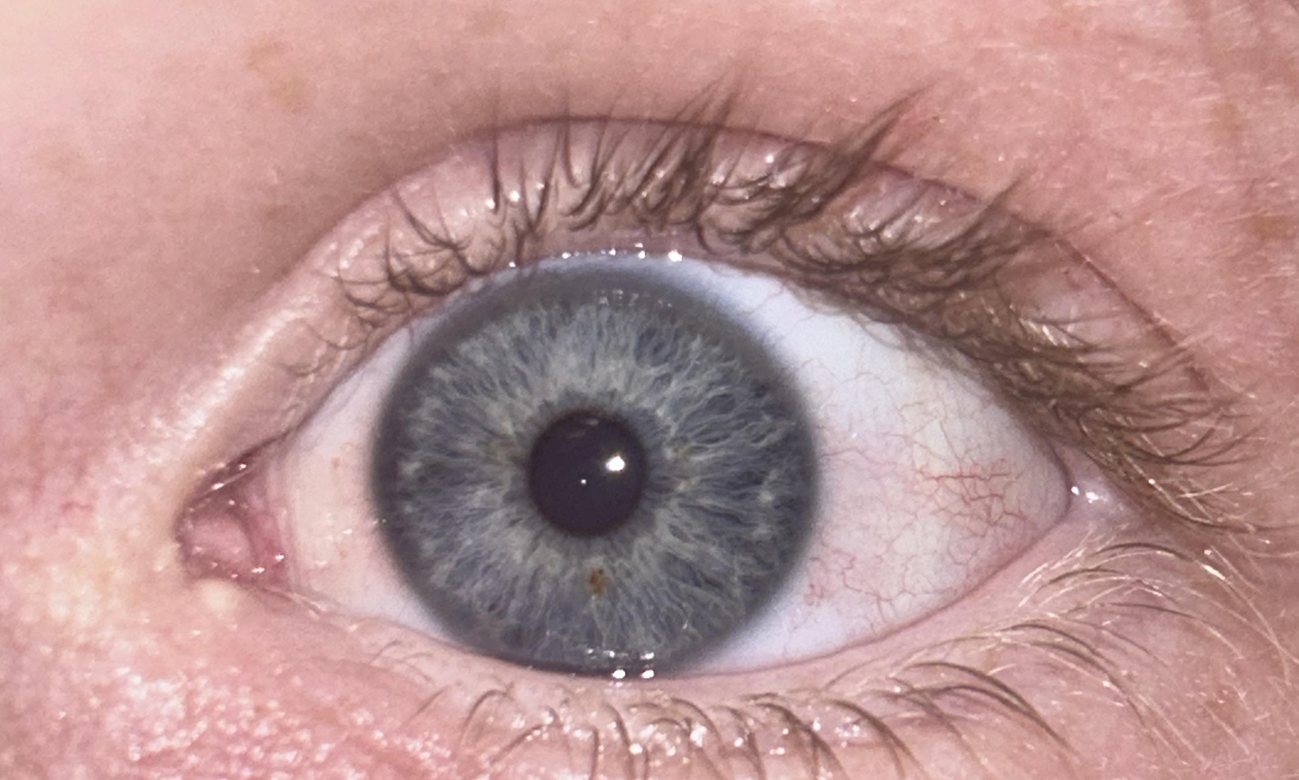 What is this brown dot on my eye? | Scrolller