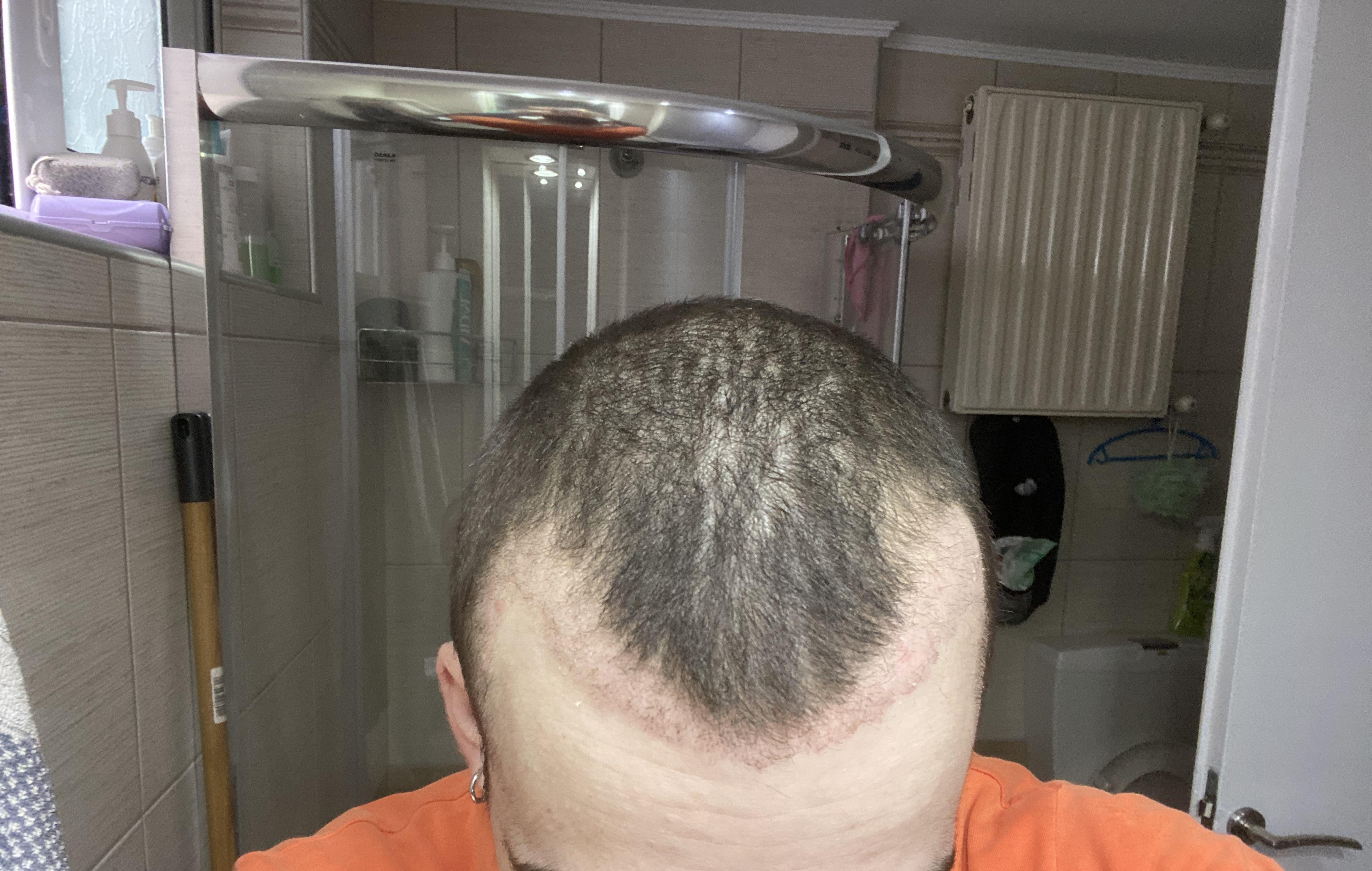 1 month post OP | Scrolller