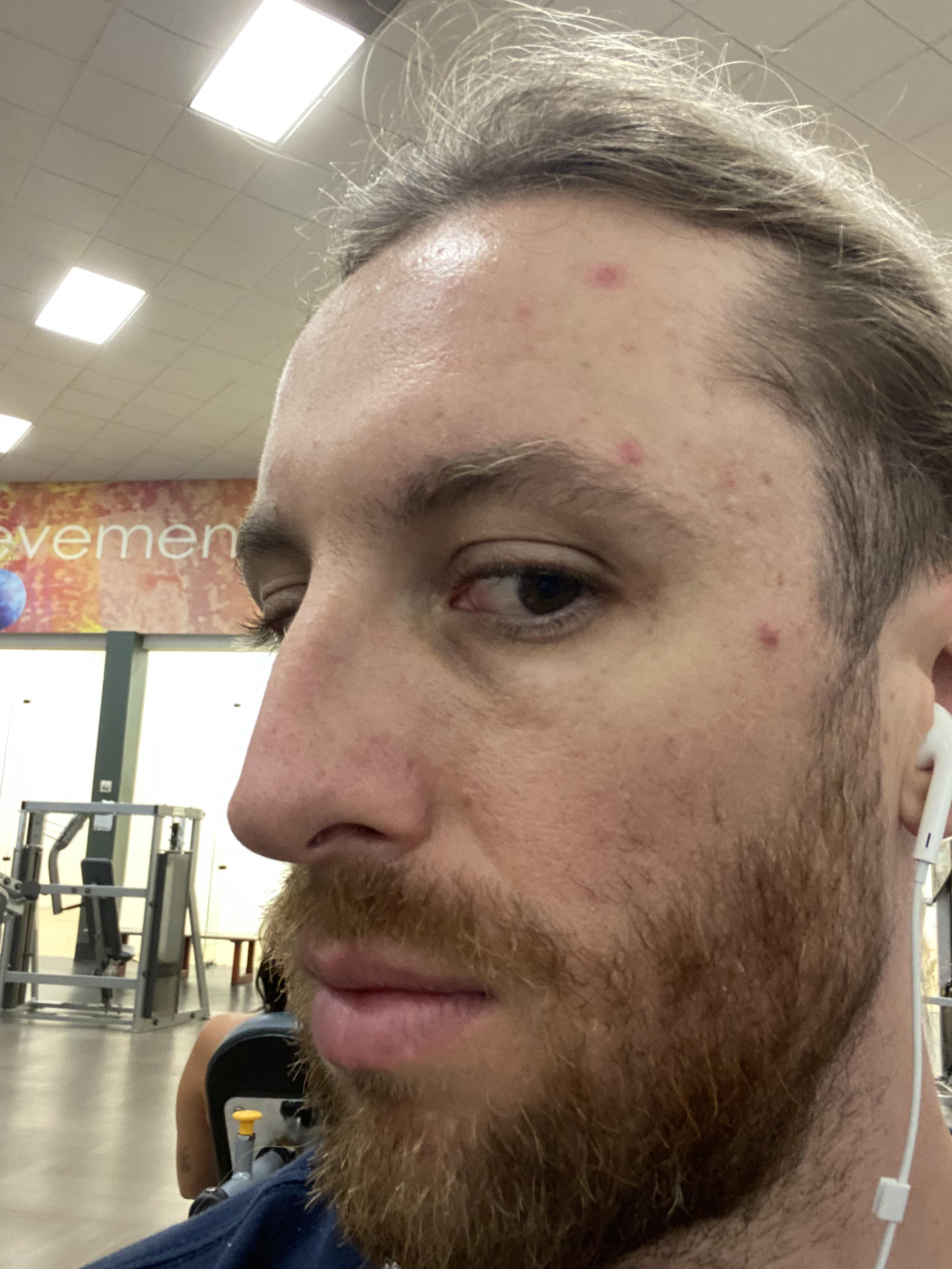 Big pimples! | Scrolller