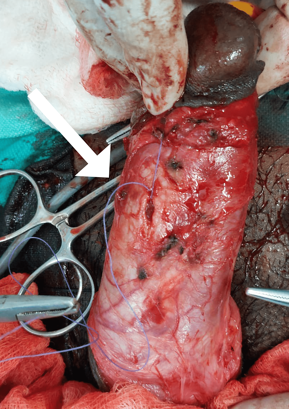 Penile fracture with urethral bleeding | Scrolller