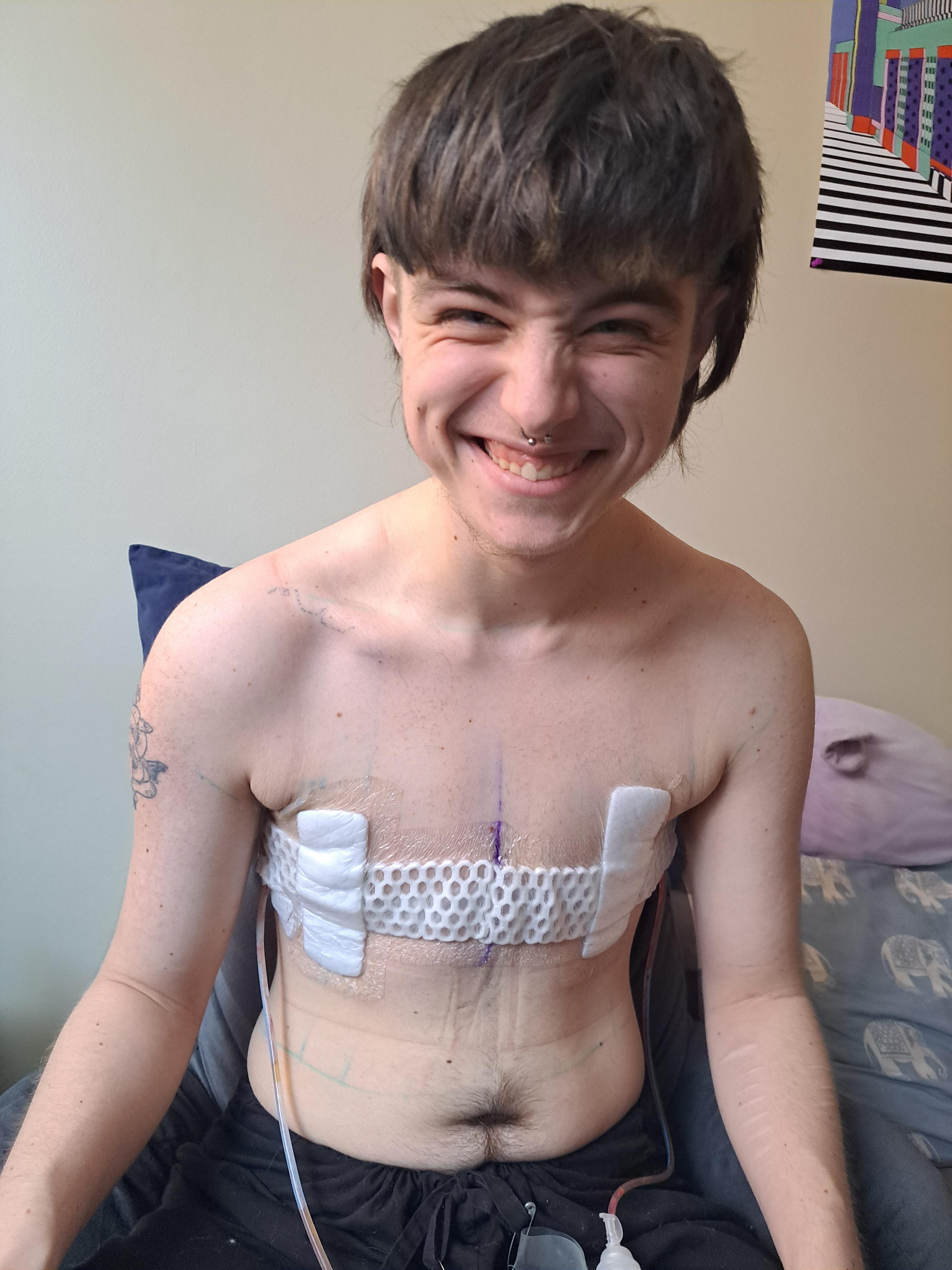 Five days Post-Op!!!! | Scrolller