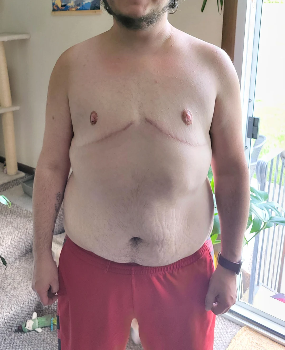 One year post-op, Dr. Upadhyaya in Syracuse NY | Scrolller