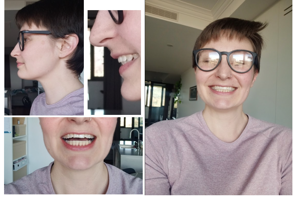 Couldn't be happier - Before & After - overjet & overbite correction | Scrolller