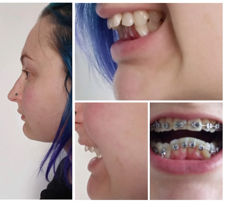 Couldn't be happier - Before & After - overjet & overbite correction | Scrolller