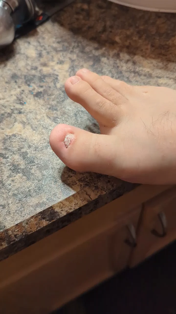 Welcome to the 3rd installment of removing the leftover toenail | Scrolller