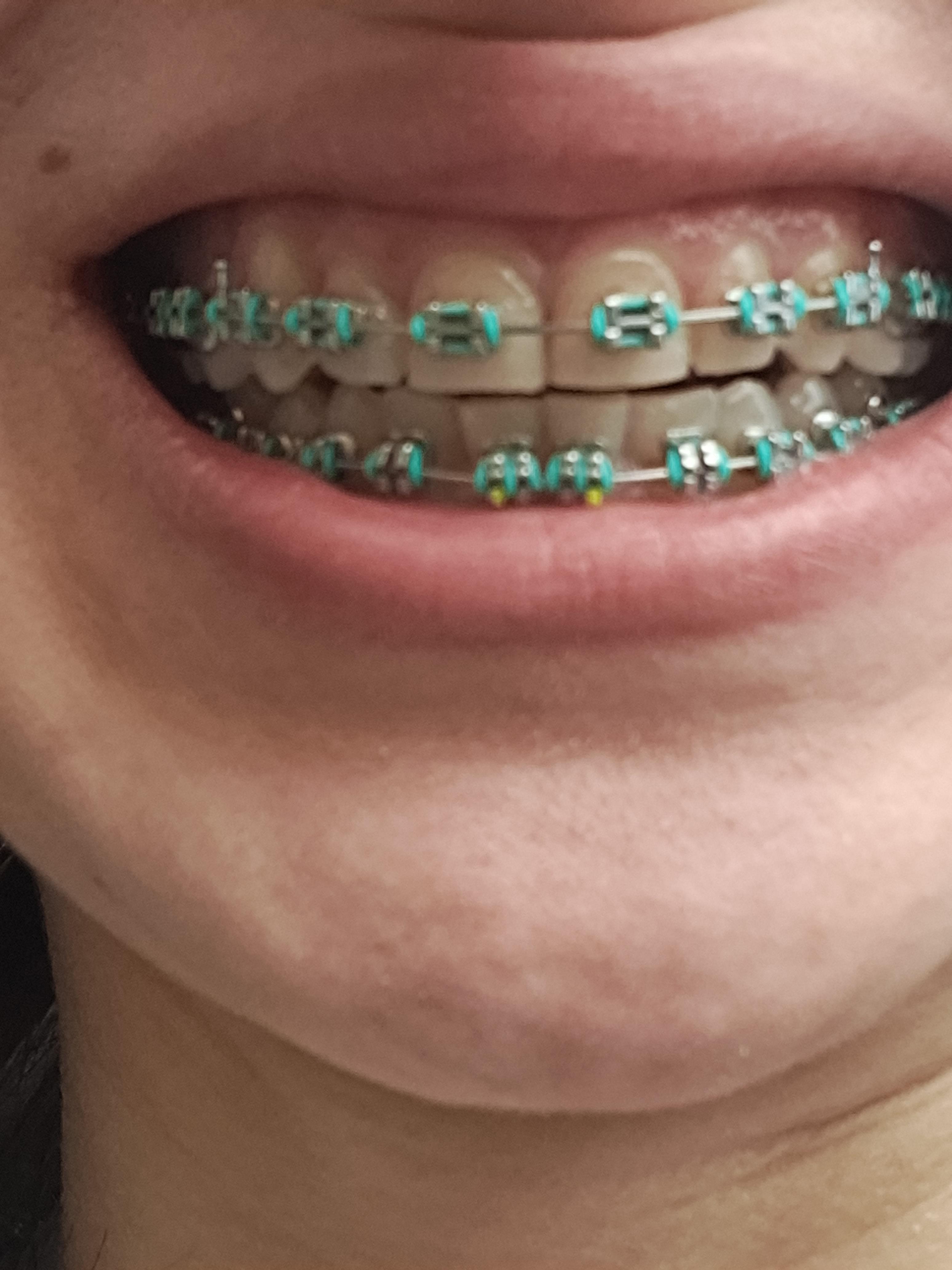 Adjustment three - finally a new colour and a full set of elastic ties ...