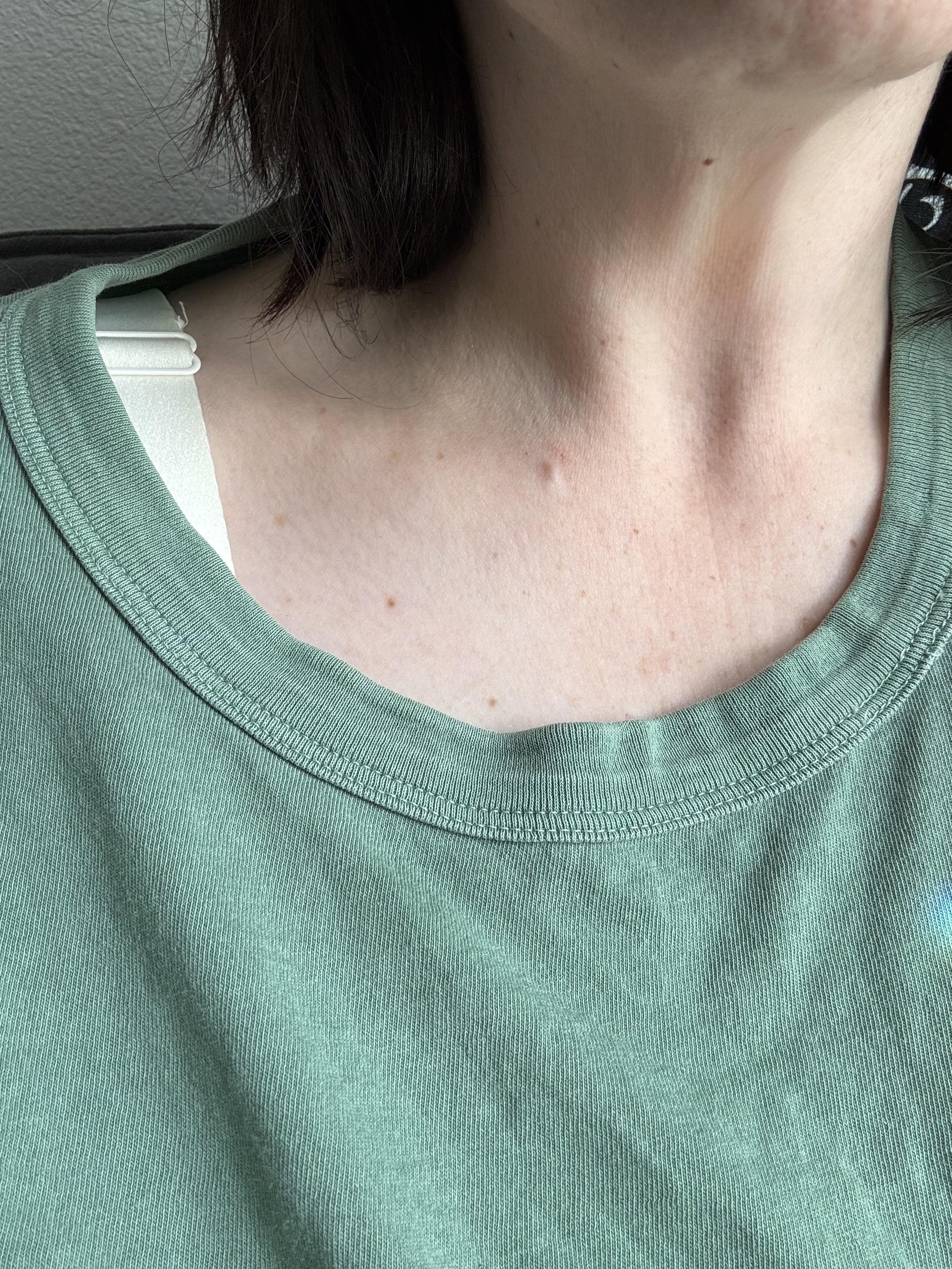 What is this bump on my collar bone? | Scrolller