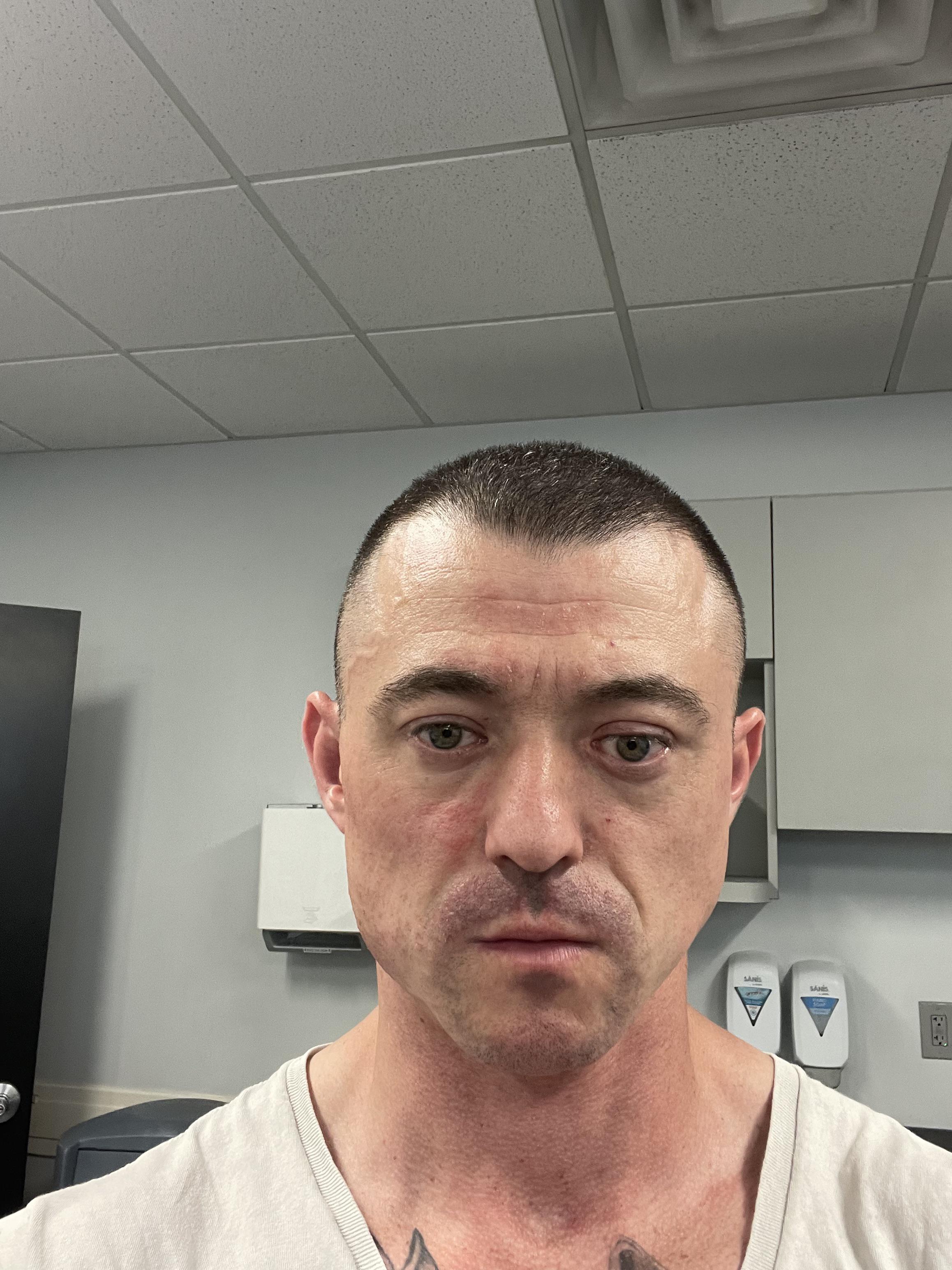 Uneven eyes | Scrolller