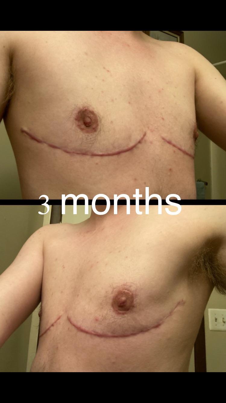 Top surgery healing progress! | Scrolller