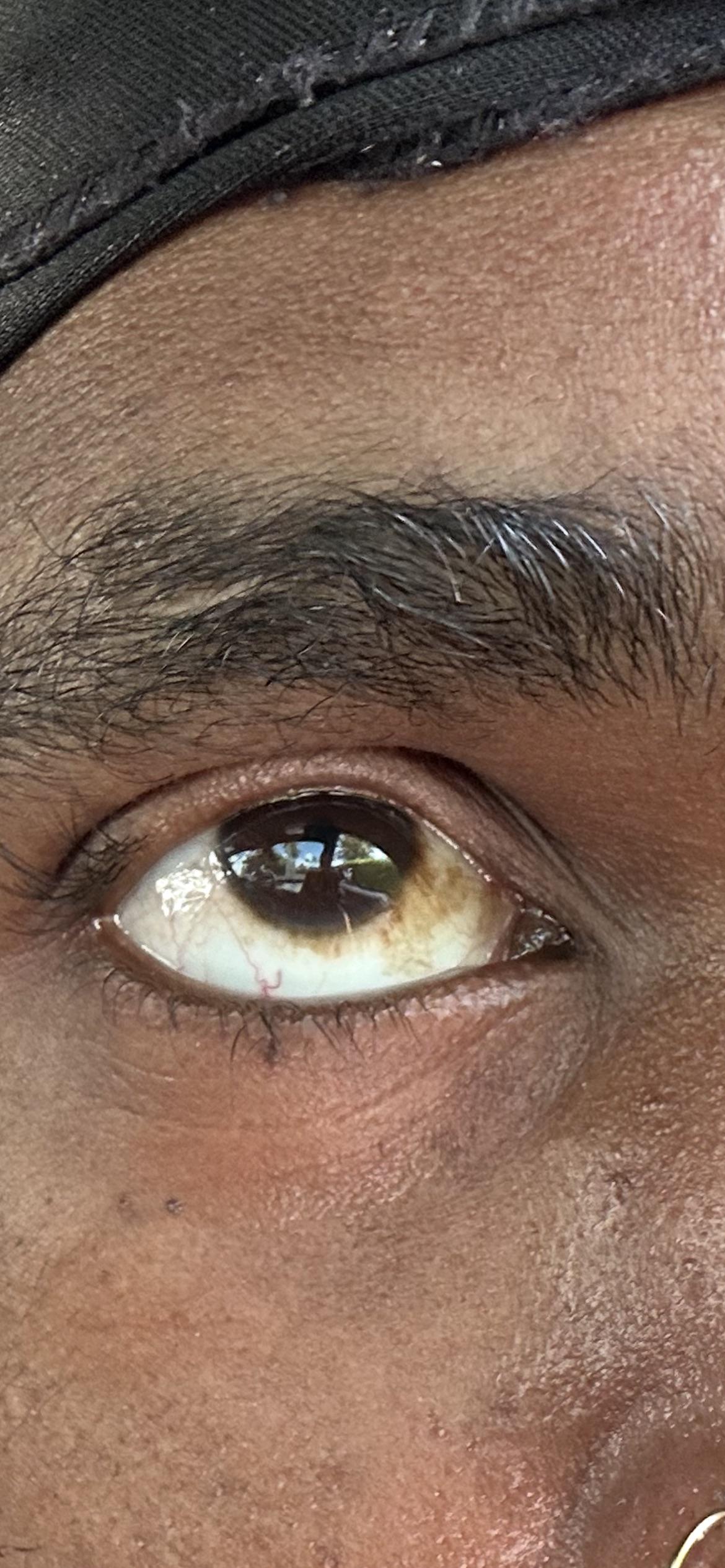 Sclera changing colors… | Scrolller