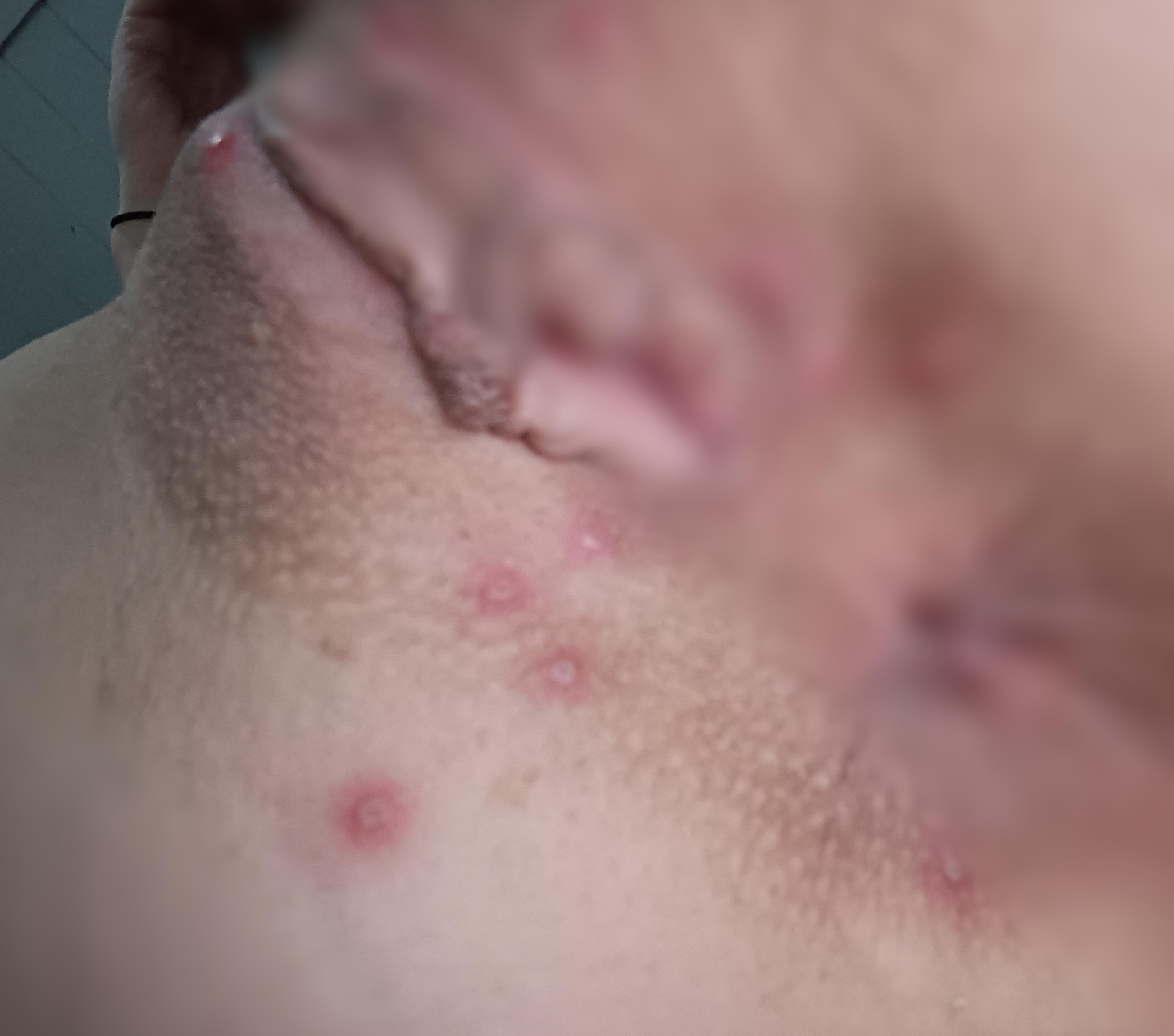 HFM? Folliculitis? HSV? | Scrolller
