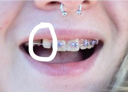 Braces ground down one of teeth? | Scrolller