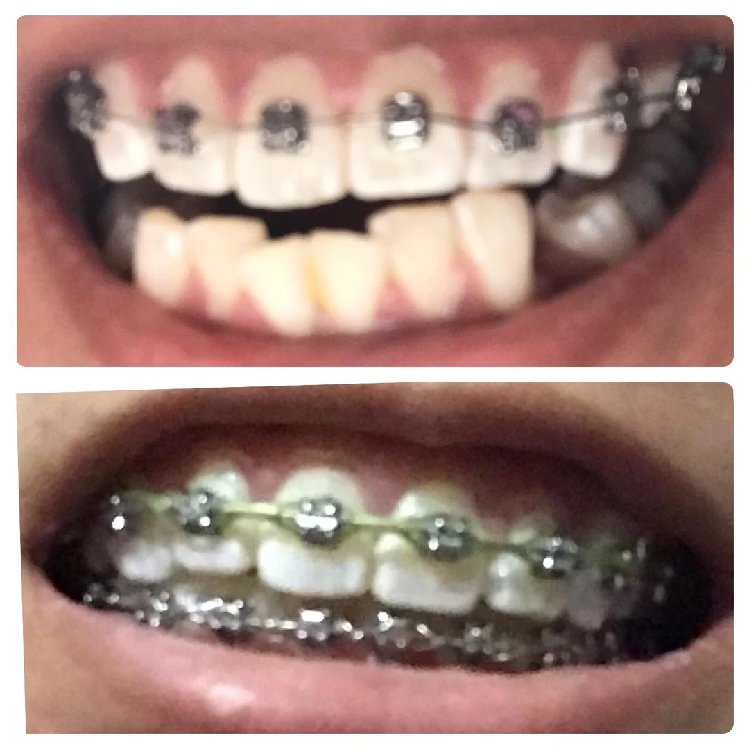 Braces Off Tomorrow After 2 Years And 3 Months Happy Scrolller