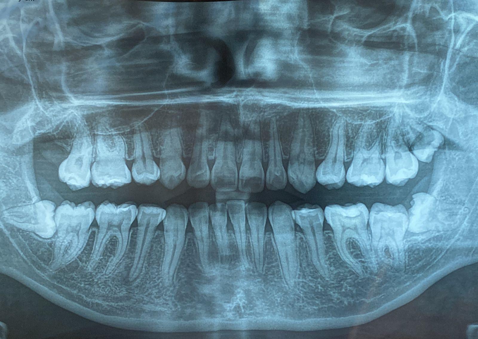 My two wisdom tooth are horizontal | Scrolller