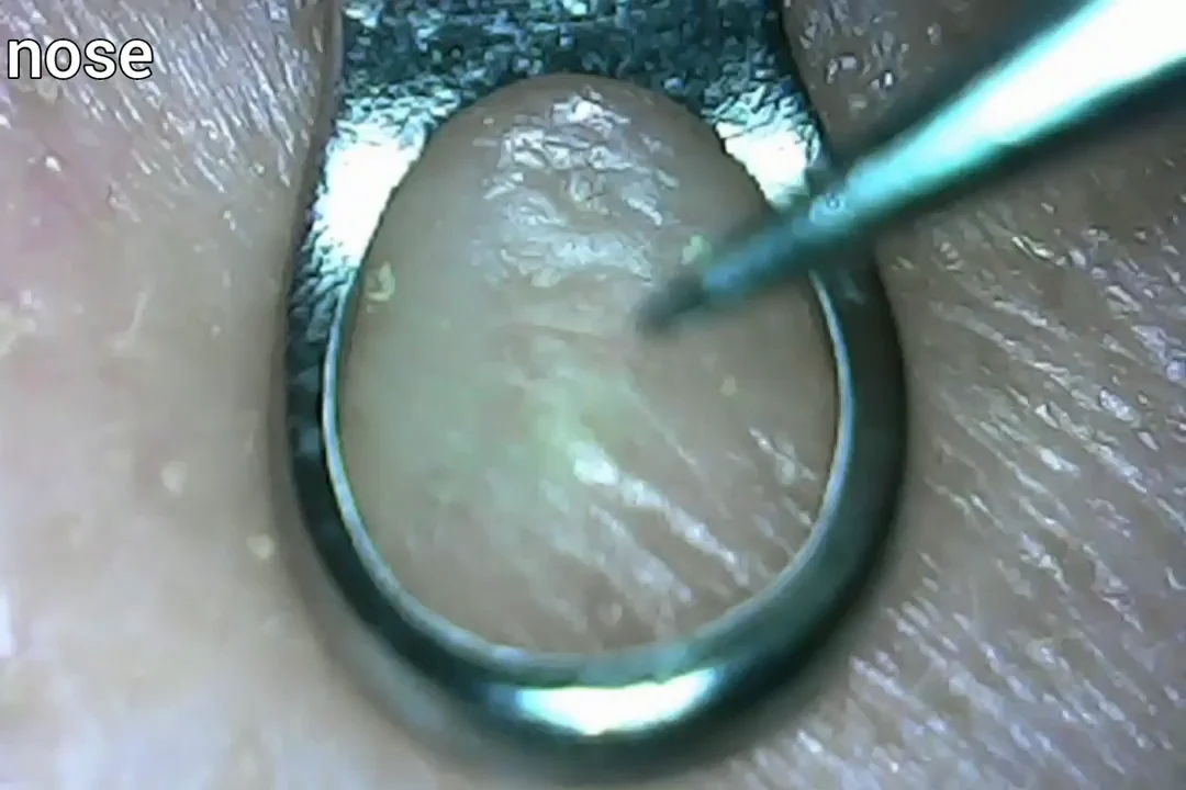 a squiggly nose pimple and other pops, most of which are whiteheads. some nice little gapers ...