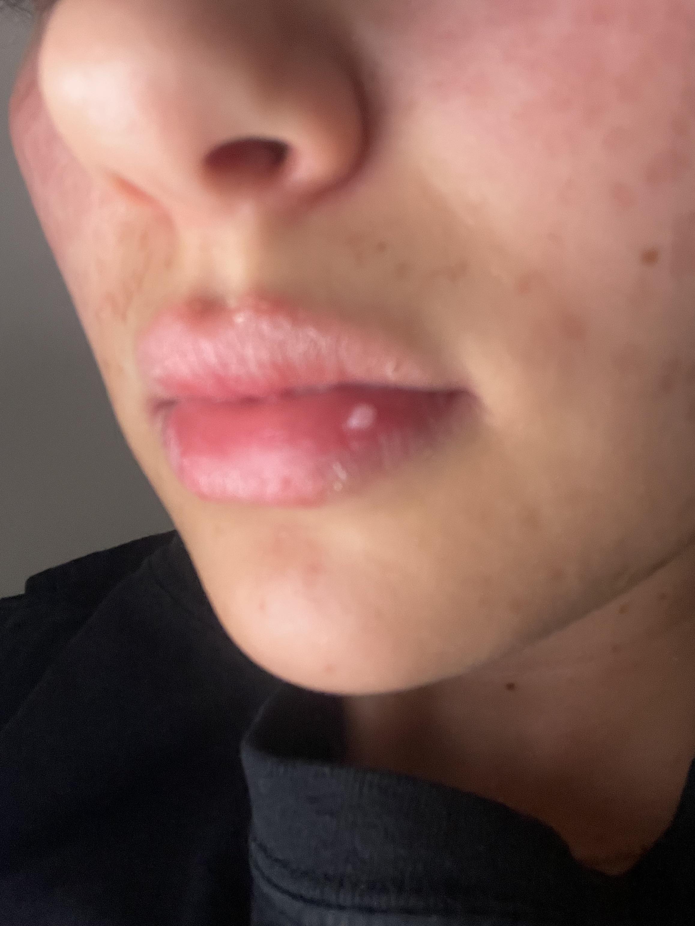 White bump on lip won’t go away | Scrolller