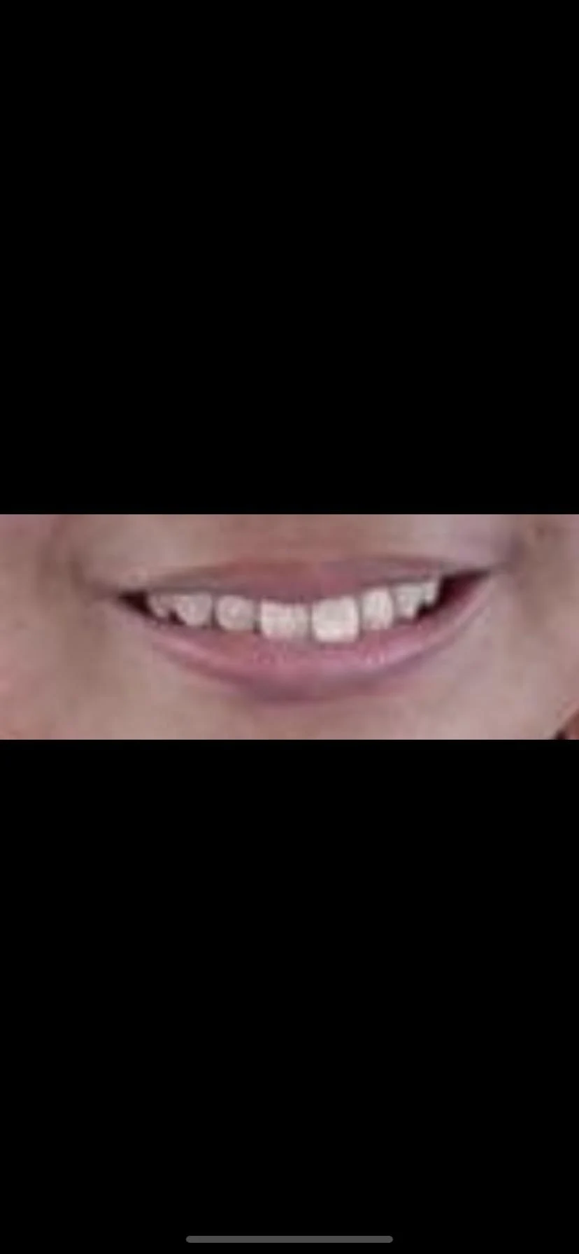Do Teeth Like These Absolutely Need Braces Scrolller