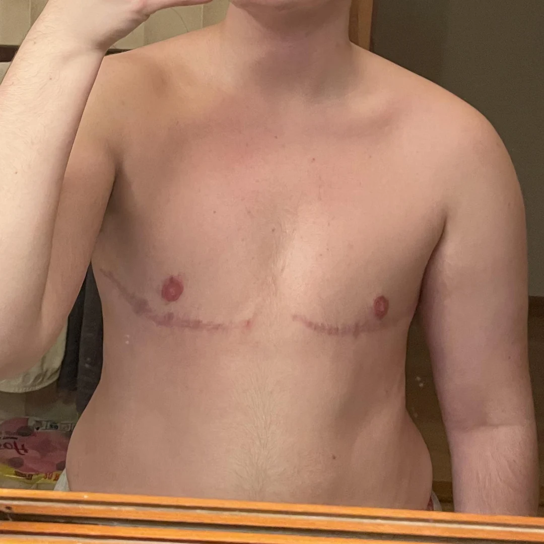 6 months post op! | Scrolller