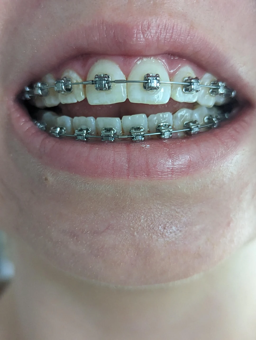 What are these white spots on my teeth? | Scrolller