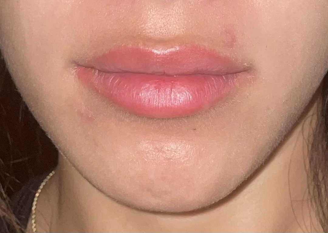 Lip filler migration | Scrolller