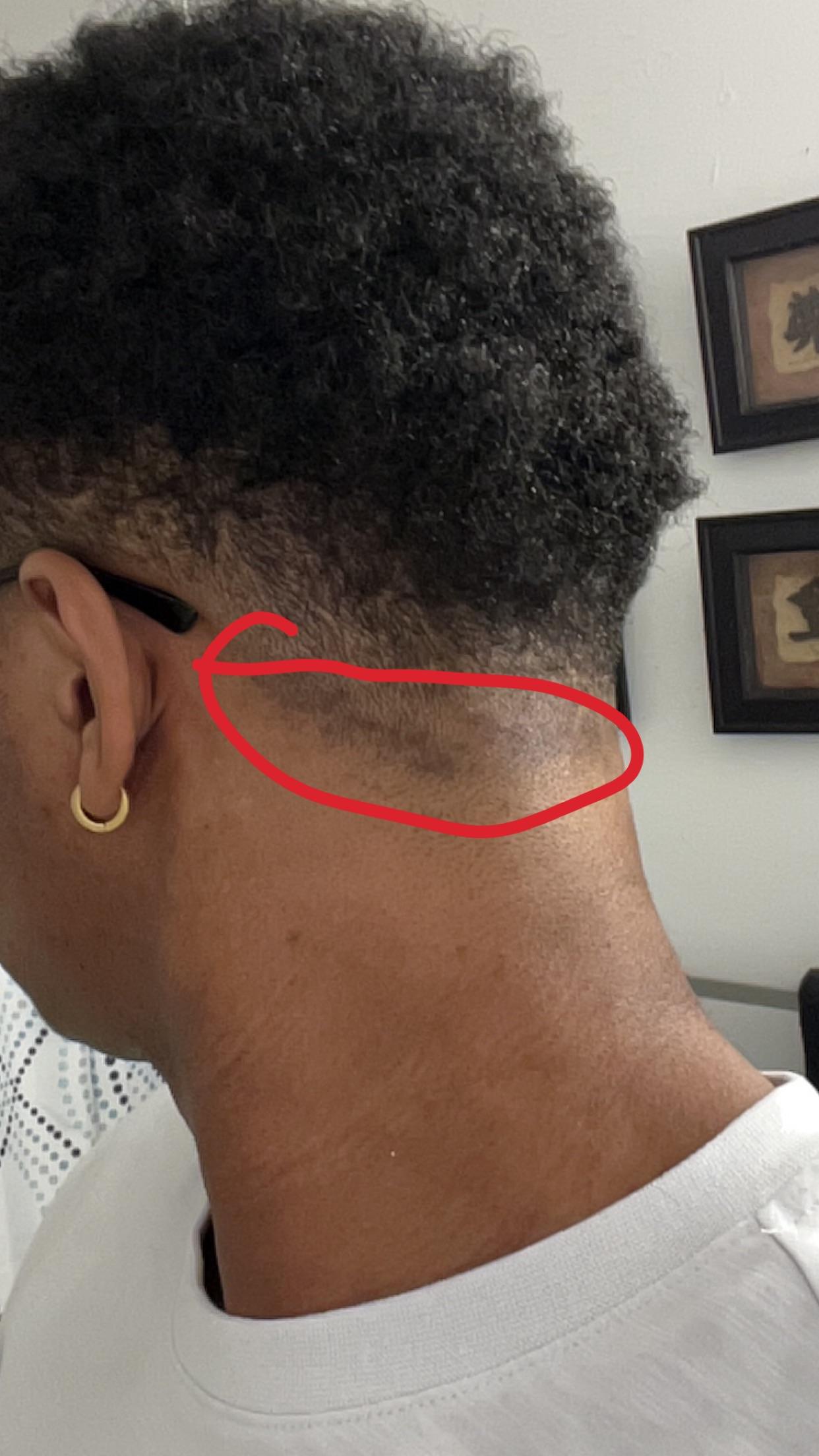 Dark spots on back of neck | Scrolller