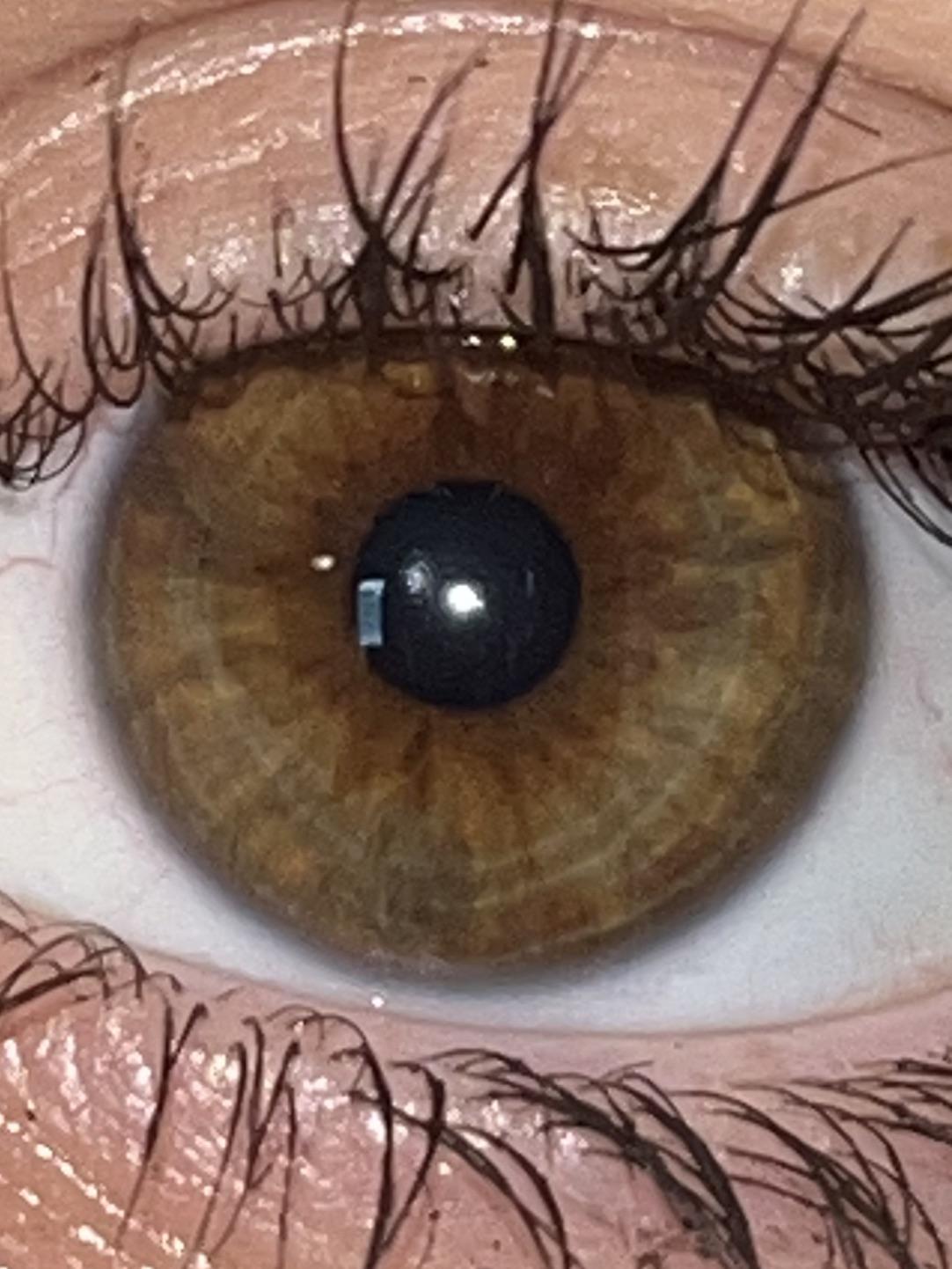 What are these rings in my eyes? | Scrolller