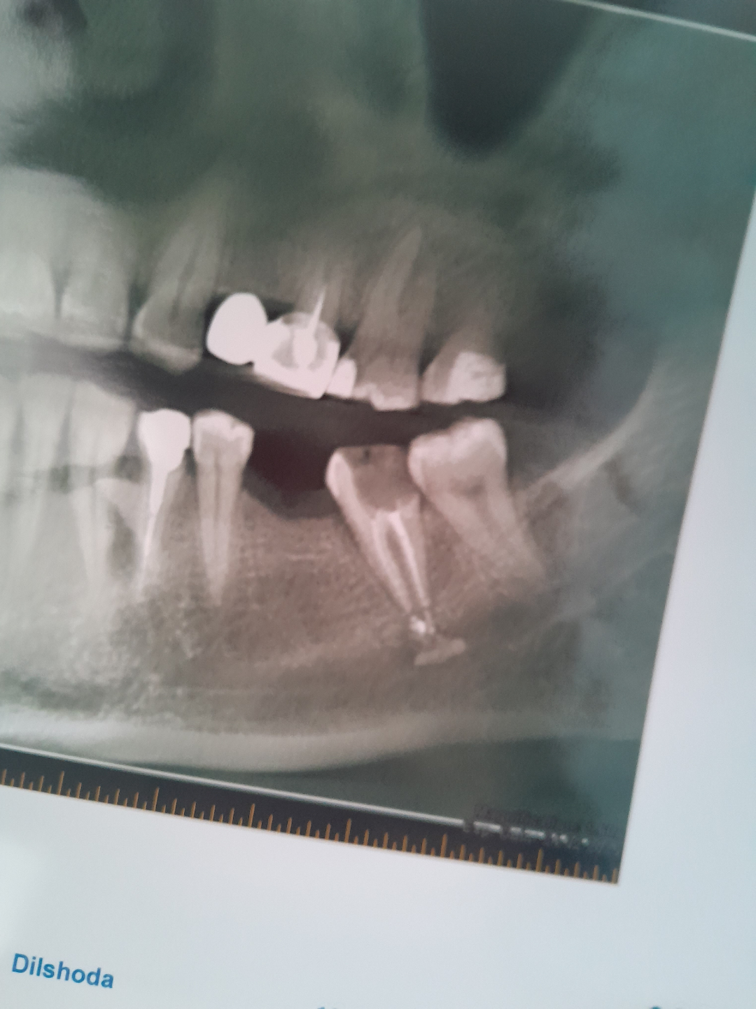 Numbness after root canal treatment on my 37th tooth | Scrolller