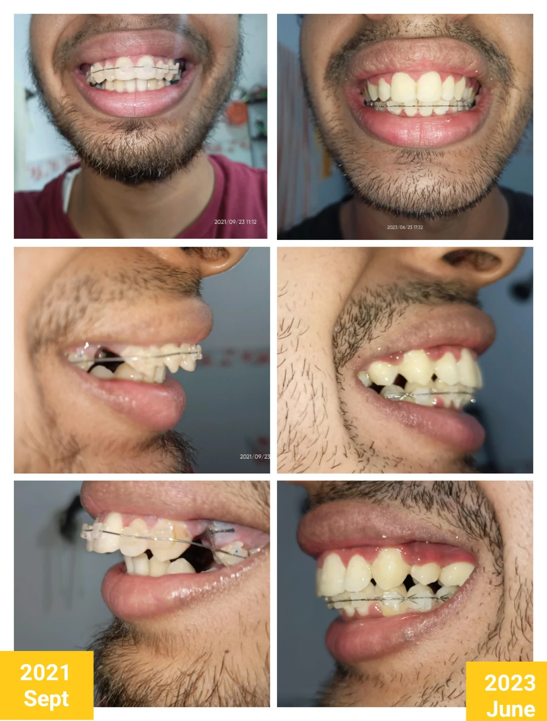 My overjet transformation | Scrolller