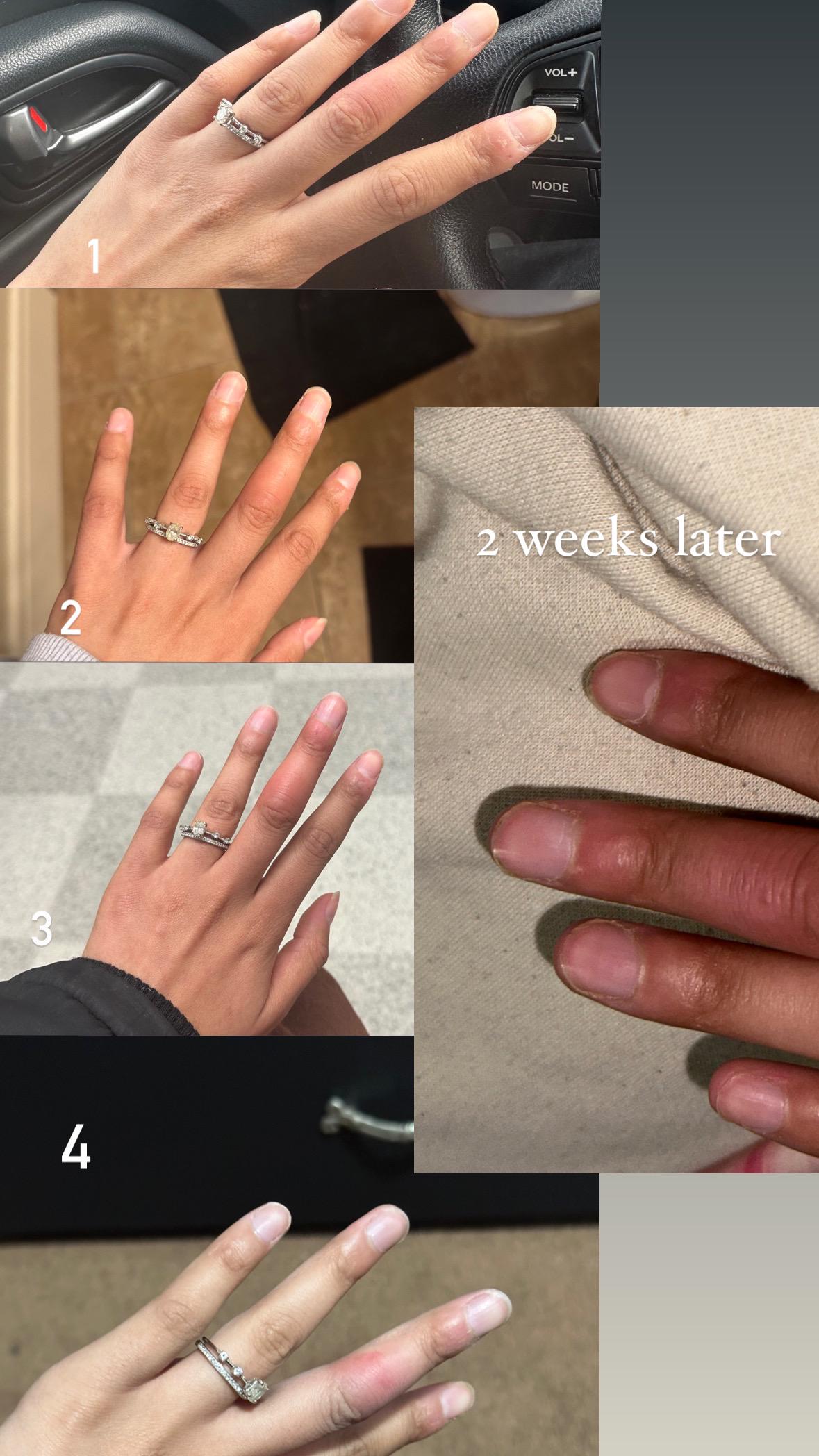 Help identifying Bug Bite : Bruised/ Swollen finger for 2 weeks | Scrolller