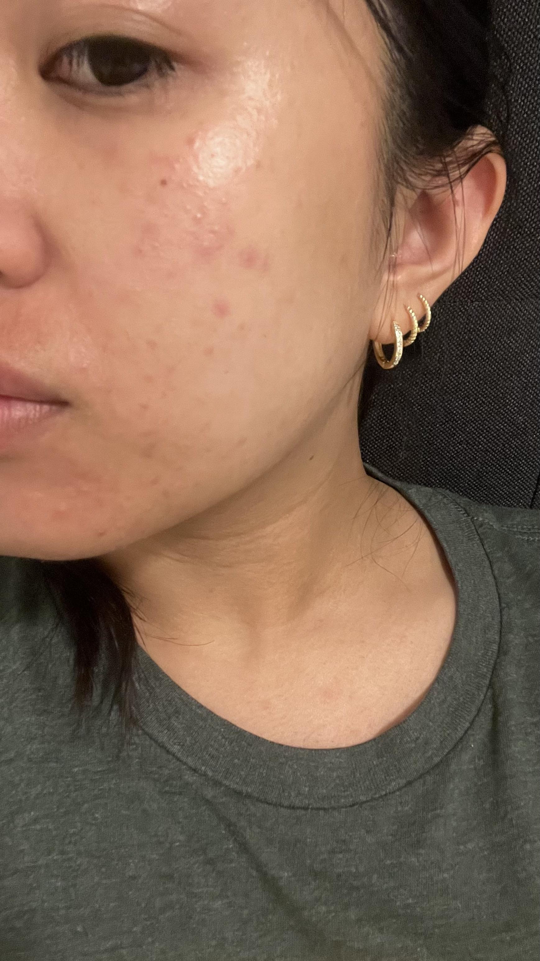 Need help figuring out what type of acne I have | Scrolller
