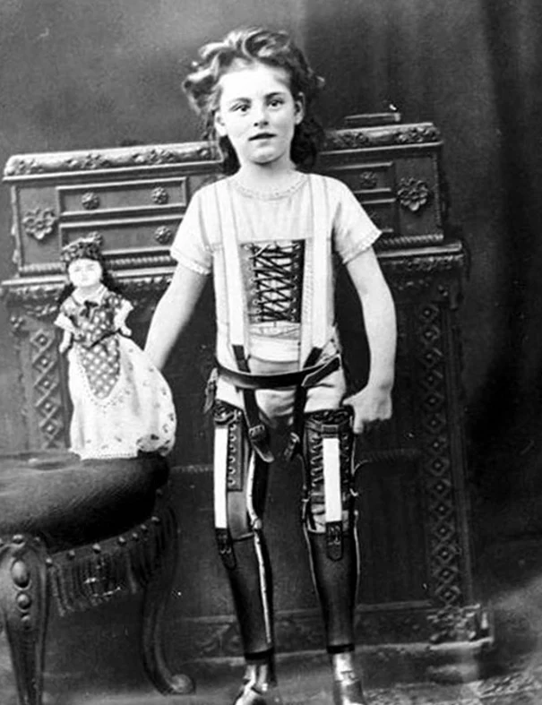 First use of prosthetic limbs on a child. Circa 1890. | Scrolller