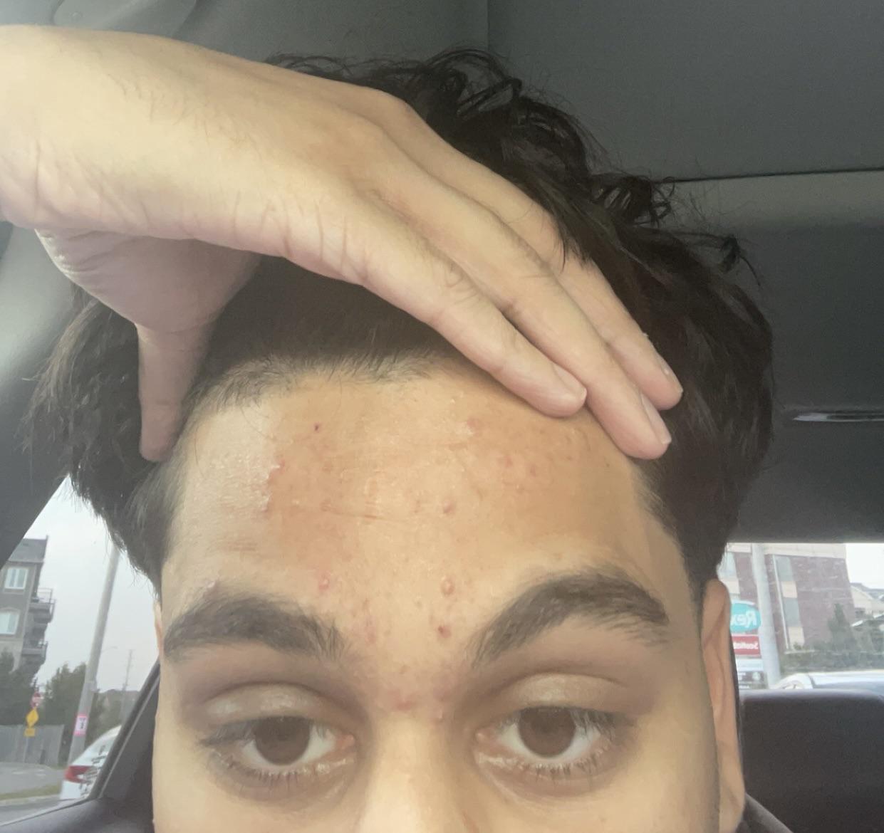 Region specific Acne! | Scrolller