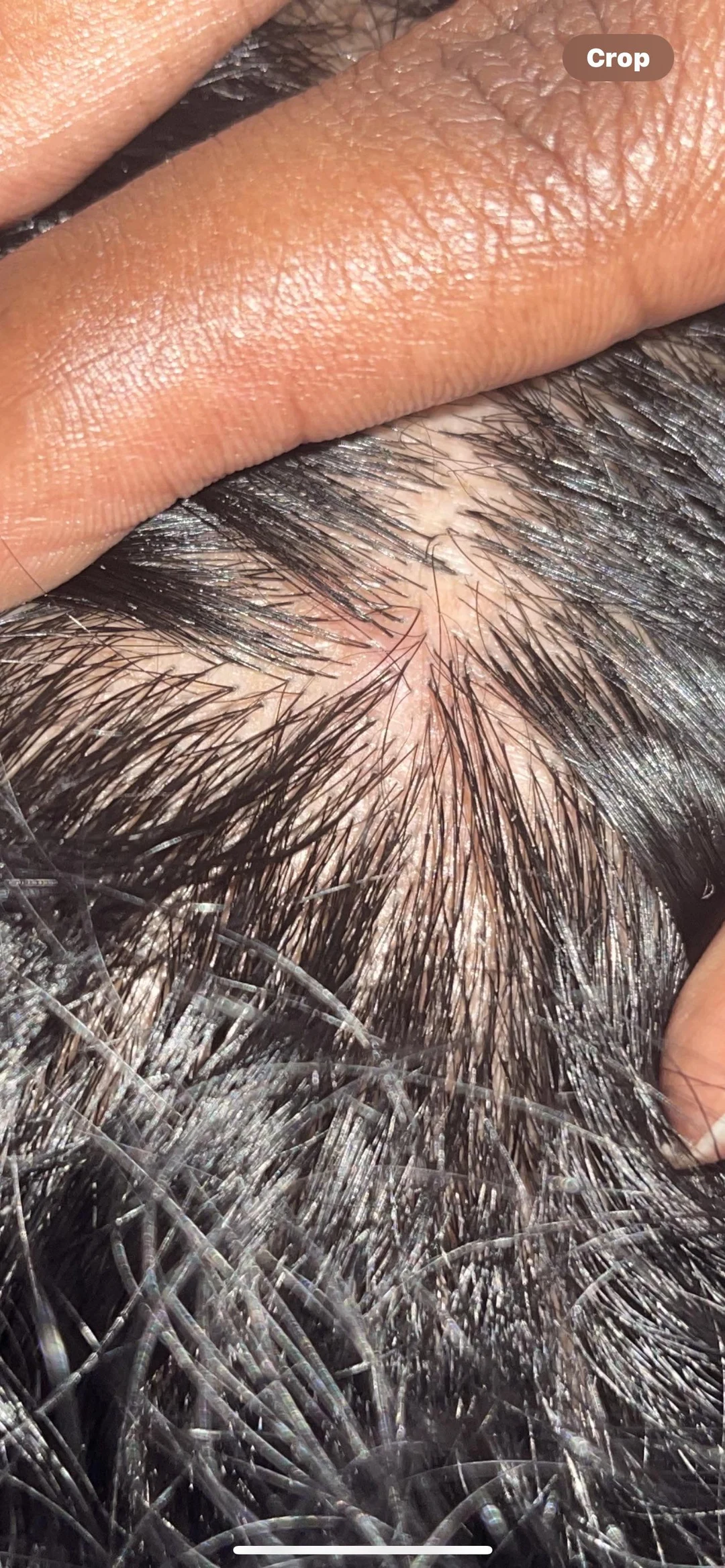I keep getting bumps in my scalp | Scrolller