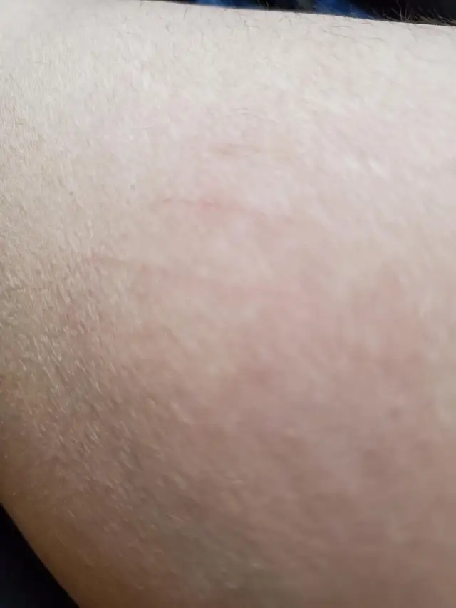 Need help- waking up with scratches and bite marks | Scrolller