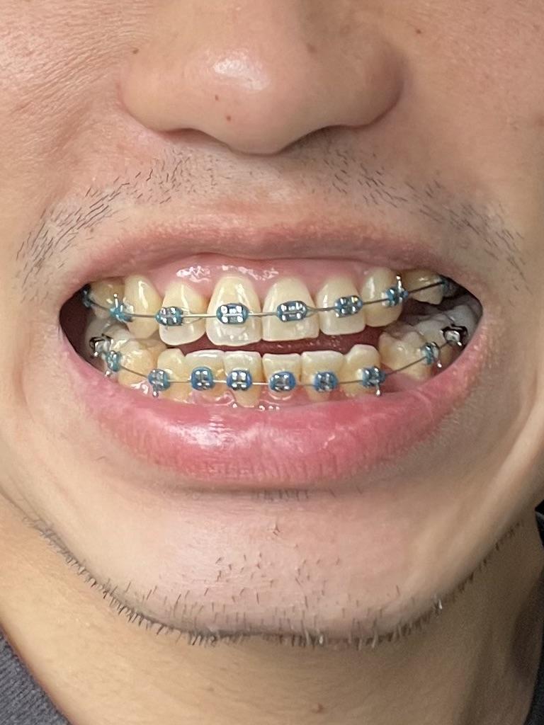 Discover More Like Braces Month 5 Of My Braces Journey And Related Content Scrolller