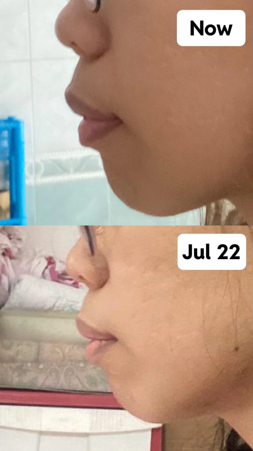 Bimax progress after 6 month of metal braces with 1st PM extractions. Any difference? | Scrolller