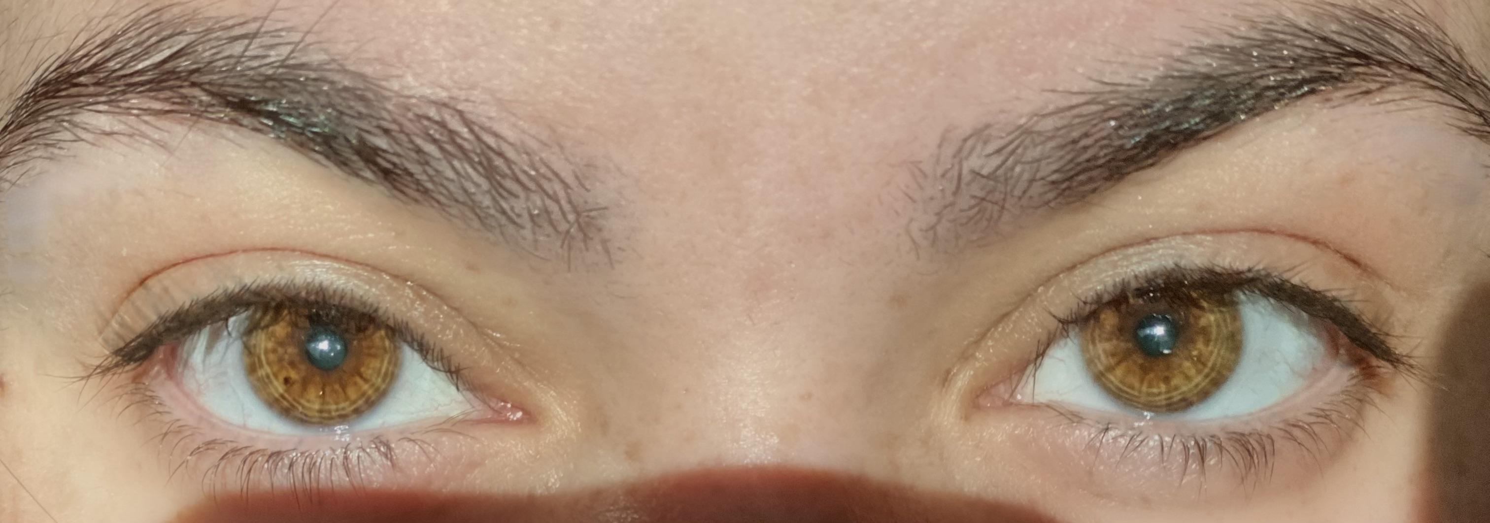 What causes these rings around the outer portion of my iris? | Scrolller