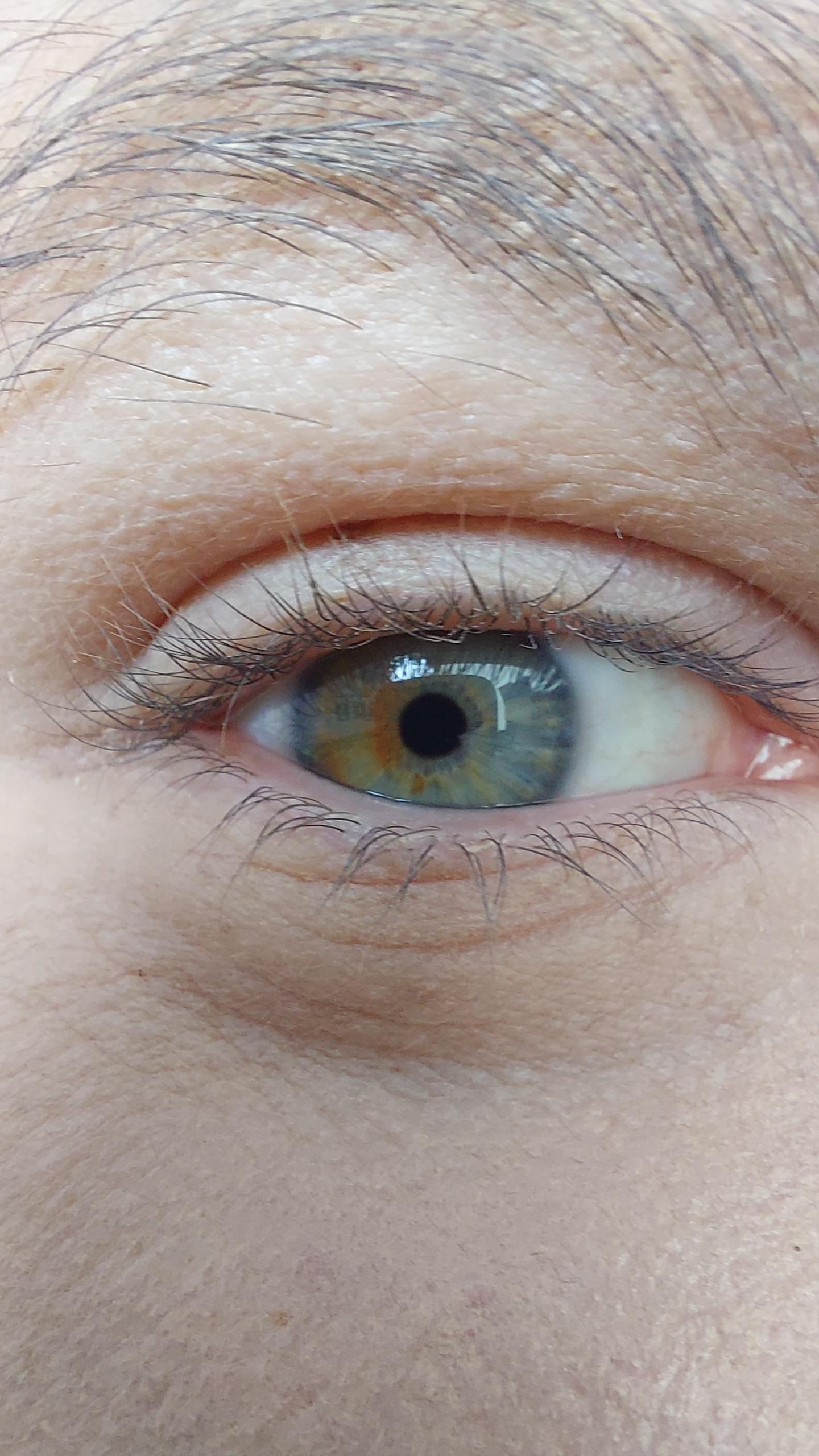 What is this called when part of your iris is in the pupil? | Scrolller