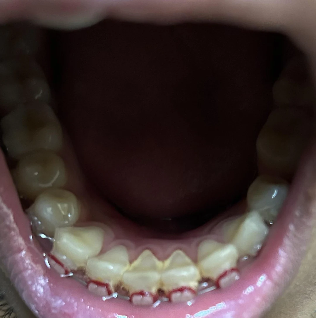 Help, deposits in lower teeth | Scrolller