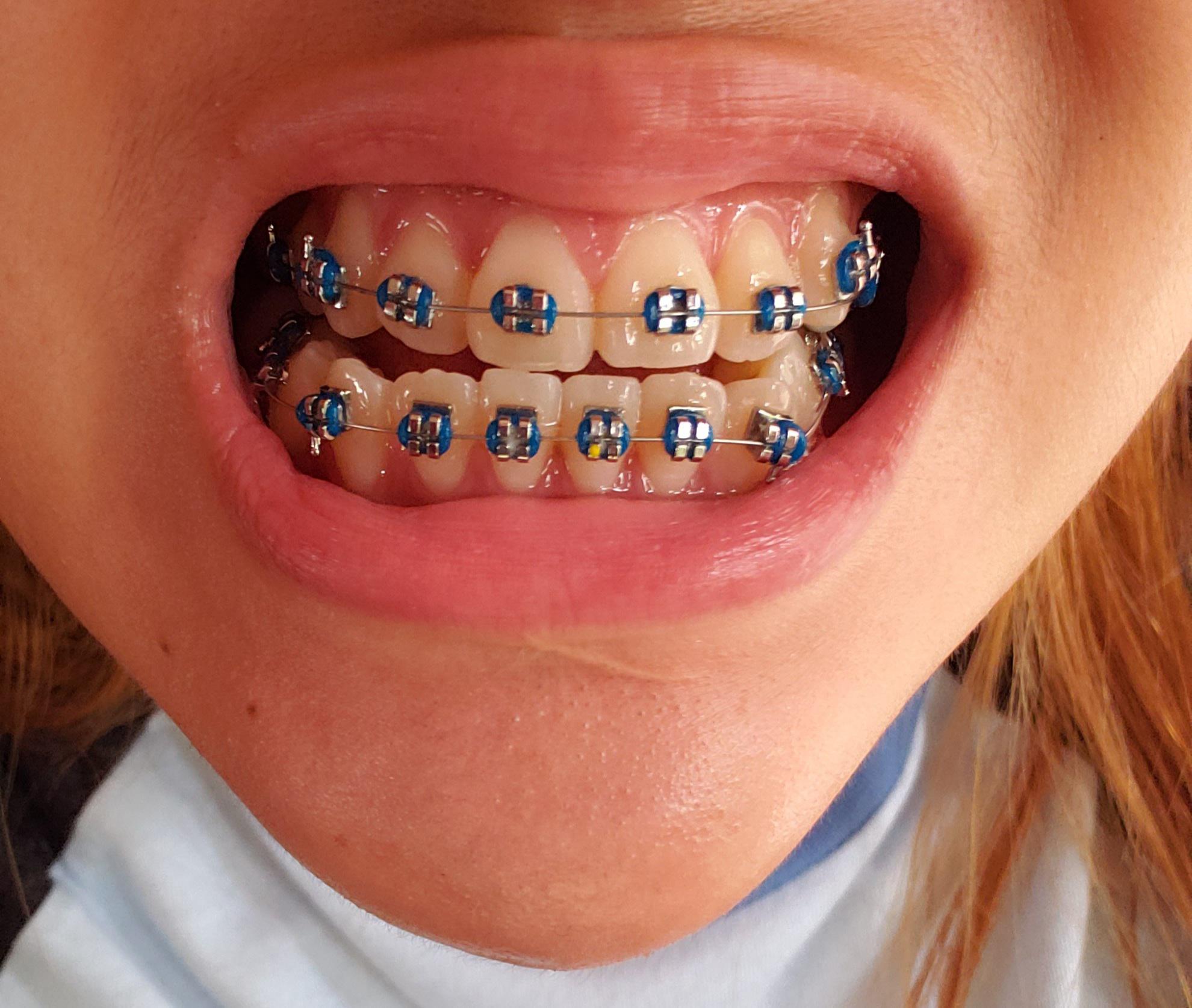 First adjustment vs now (6th!) For how long this suffering shall stay :/ | Scrolller